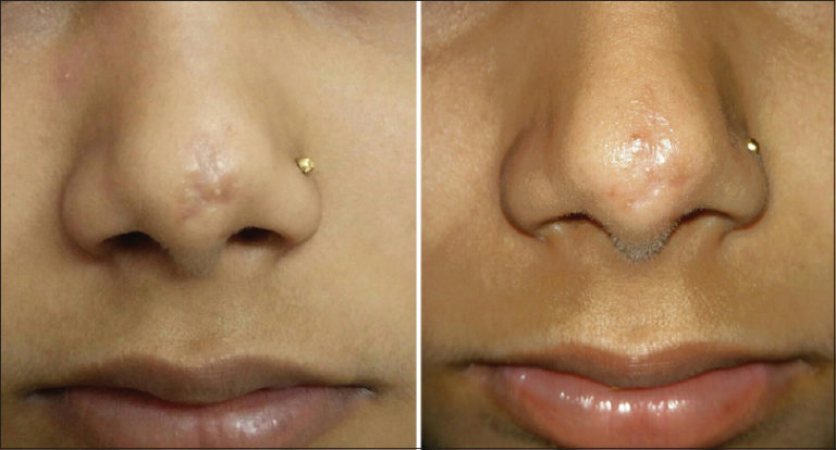 MICRONEEDLING SURGICAL SCARS – Areton Limited