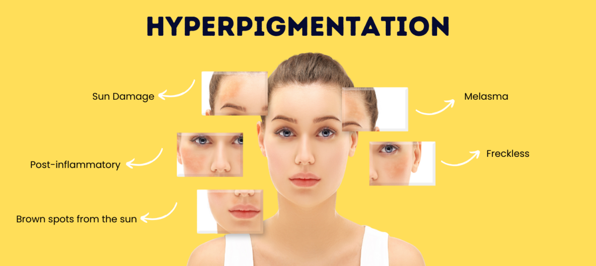 Hyperpigmentation: Types, treatment, and causes - Areton