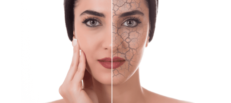 Rough Dry Skin: Types, Risk Factors, and Treatments - Areton