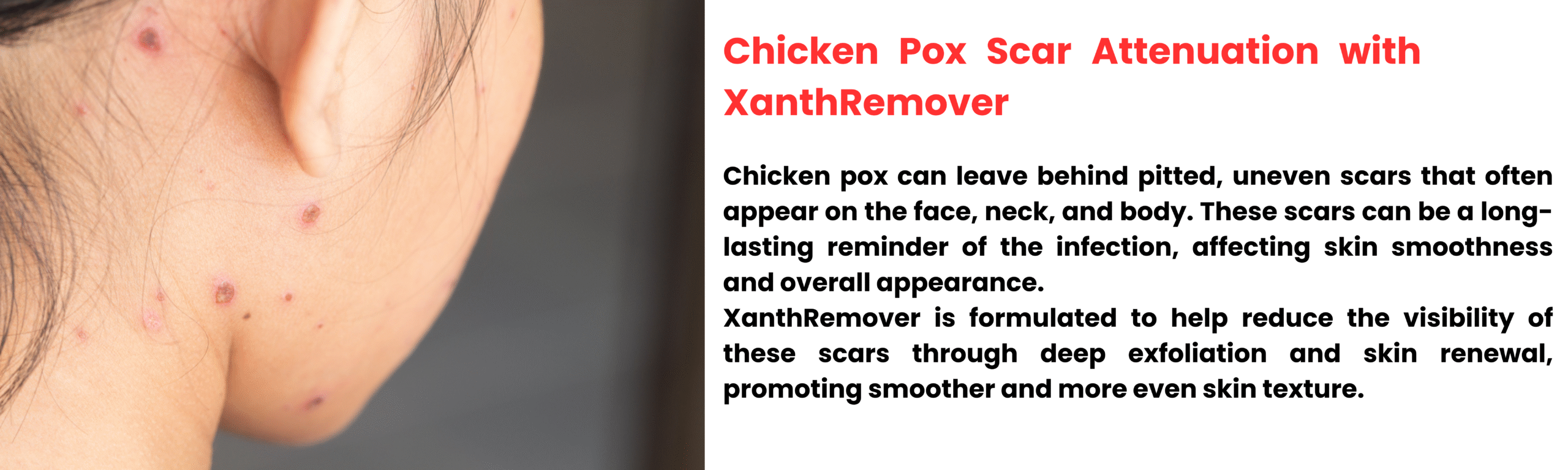 Chicken Pox Scar Attenuation with XanthRemover - Areton